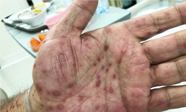 What Is Secondary Syphilis? | Genetrack Biolabs